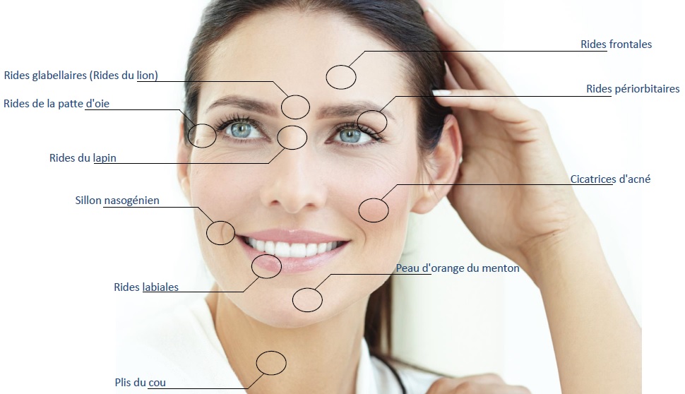 Les traitements efficaces contre les rides et ridules